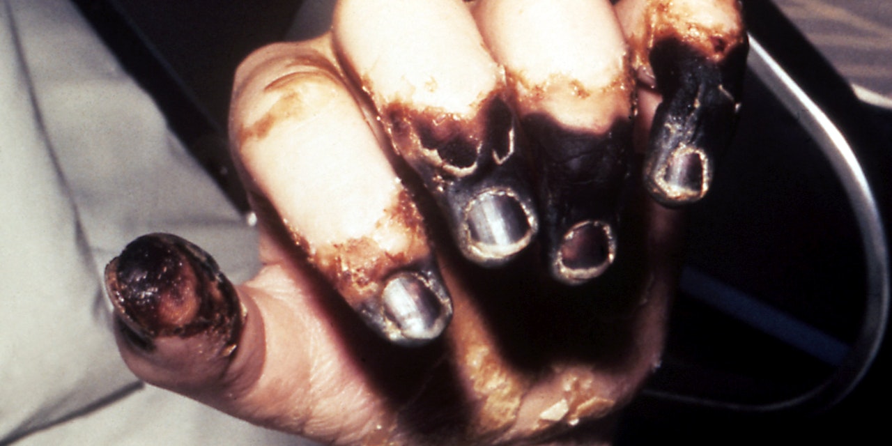 Welt – Bub stirbt an Beulenpest, Dutzende müssen in Quarantäne | Heute.at