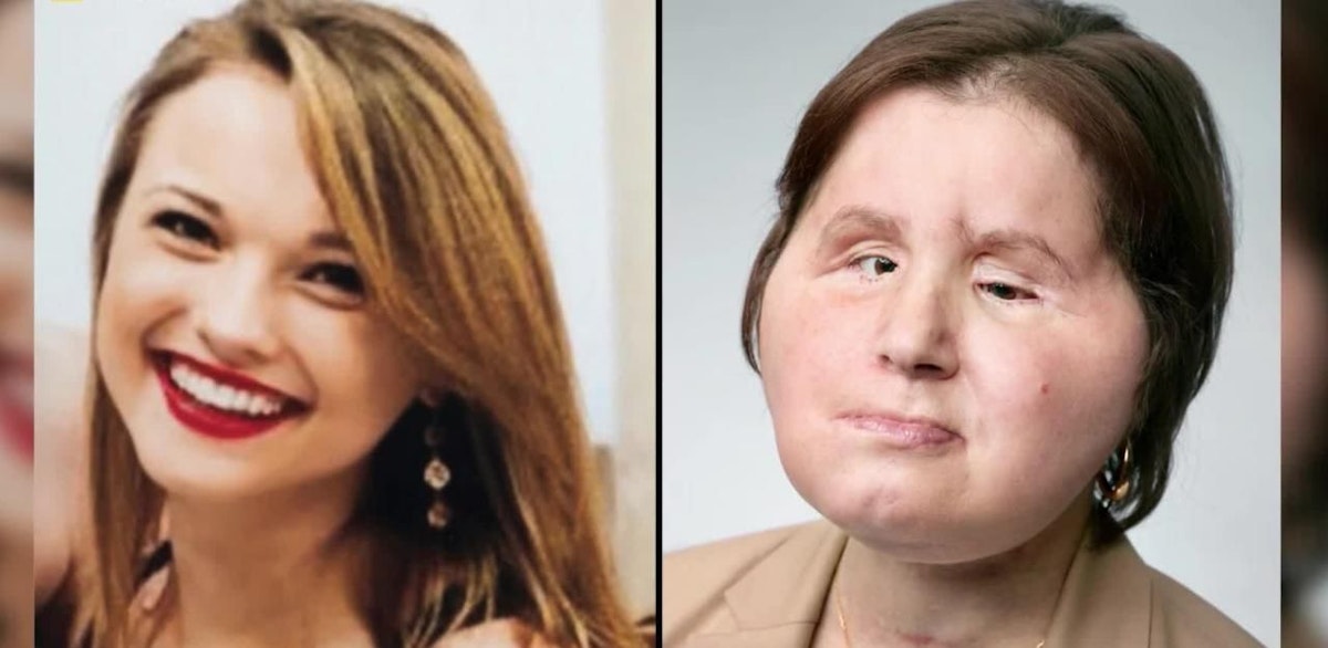 Life – Katie Stubblefield lebt mit dem Gesicht einer Fremden | Heute.at