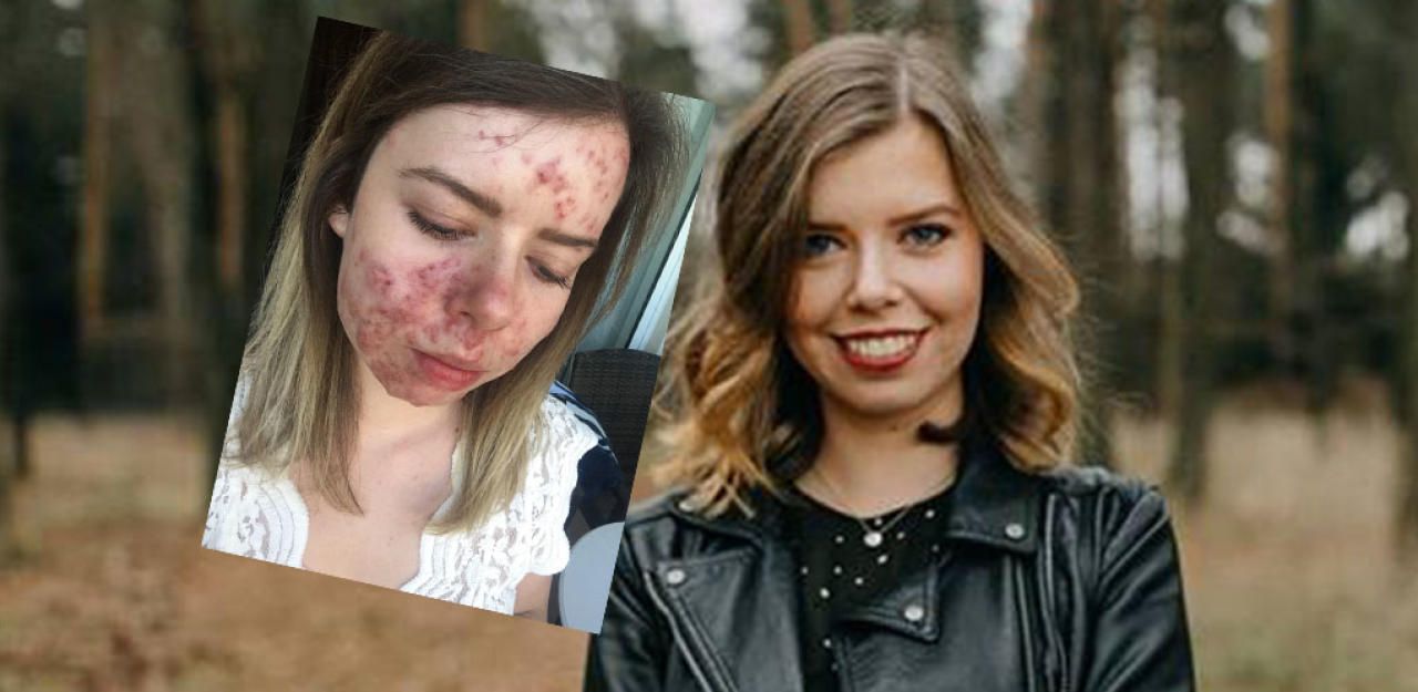 Steirerin setzte Pille ab: "Leide jetzt an Akne" | Heute.at