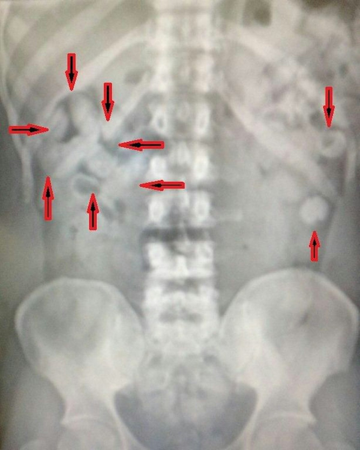 Österreich – Bodypacker trug ein Kilo Koks im Körper | Heute.at