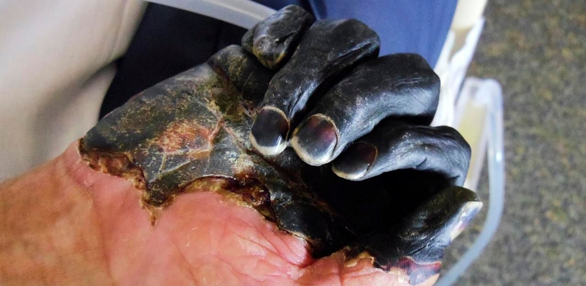 Life – Die Pest ist wieder da – das steckt dahinter | Heute.at