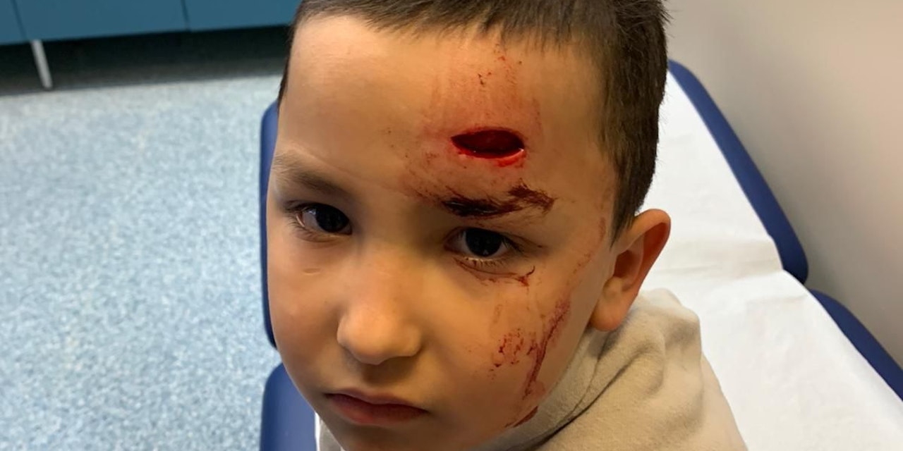 Niederösterreich – Mutter zeigt Schule an: "Sohn hat Riesen-Cut am Kopf ...