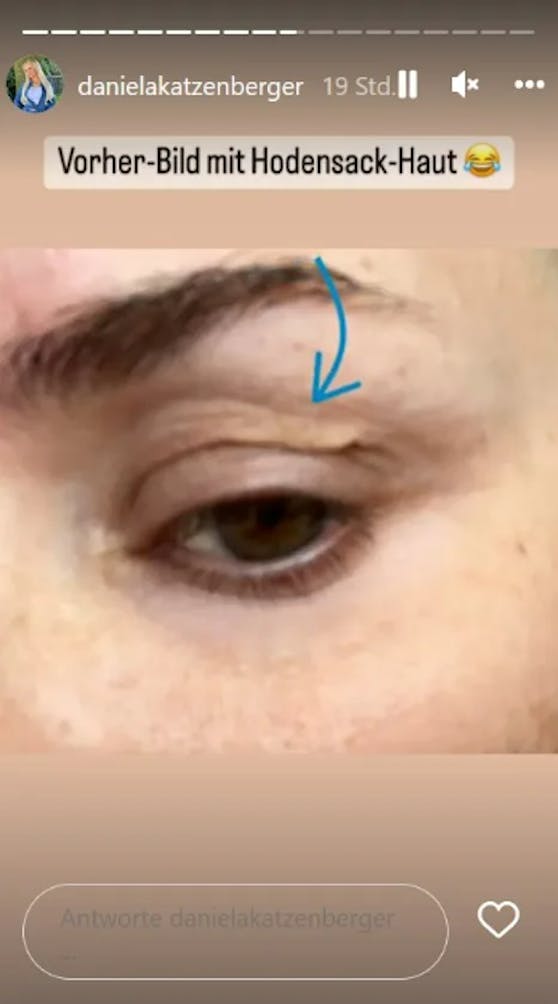 "Hodensack-Haut" – Daniela Katzenberger gesteht OP - People | heute.at