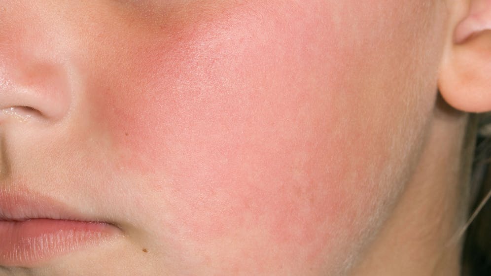 Diese Infektionskrankheit ist nun auf dem Vormarsch | Heute.at