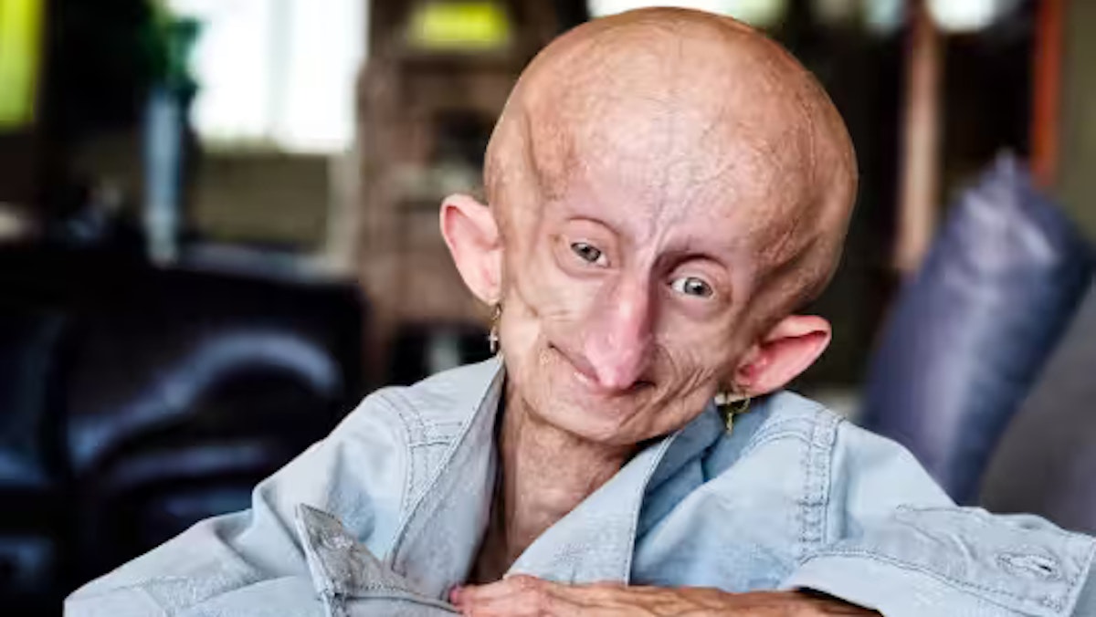 Progerie – TikTok-Star Beandri stirbt mit 19 an seltenem Gendefekt ...